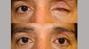 Prótesis Oculares - Laboratorio Óptico